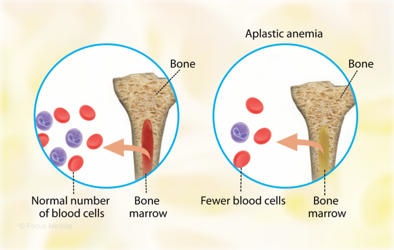 Aplastic Anemia in Children - Best Aplastic Anemia Doctors in India